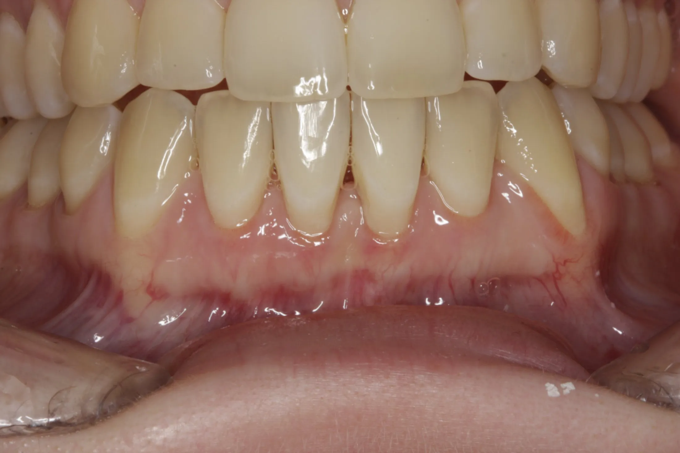 Free Gingival Graft Issaquah WA, Northwest Periodontics & Implants