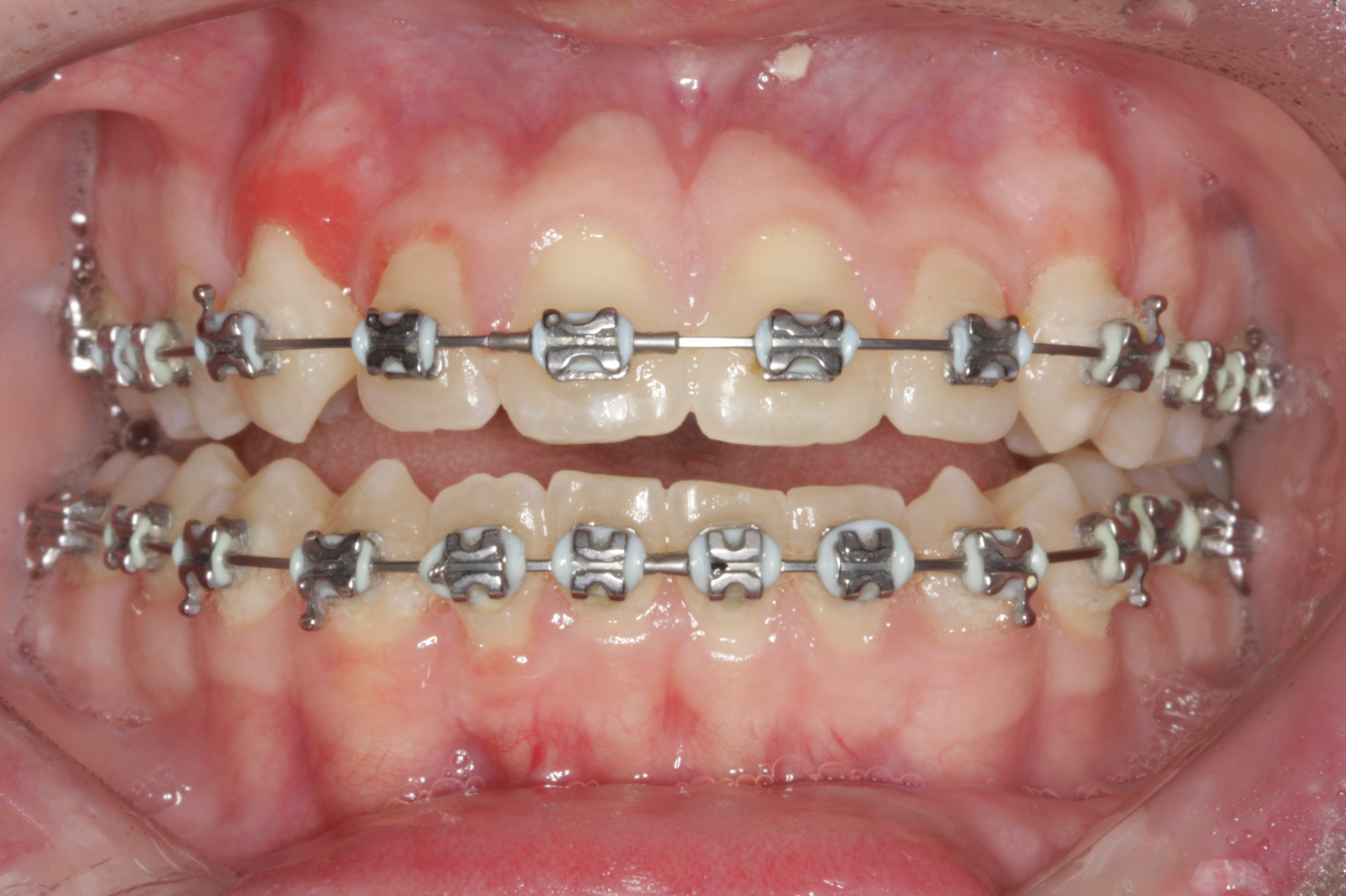 Canine exposure Issaquah WA, Northwest Periodontics & Implants