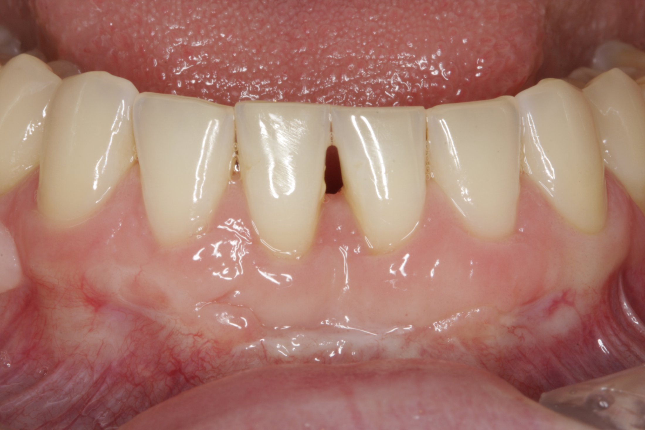 Free Gingival Graft Issaquah WA, Northwest Periodontics & Implants