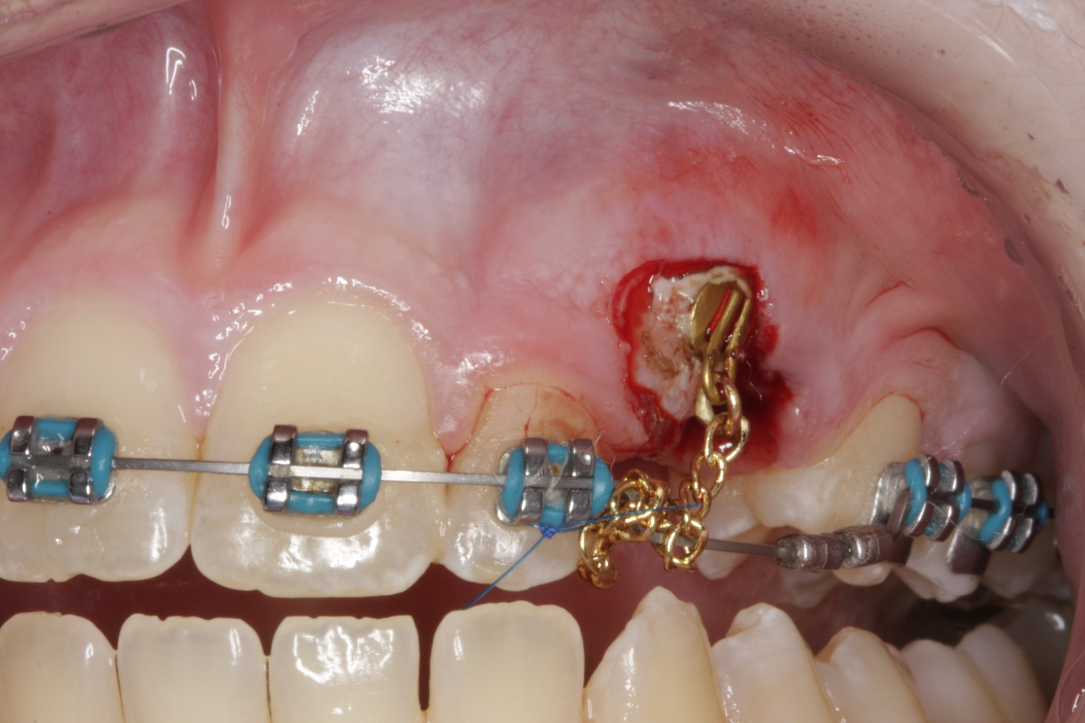 Canine exposure Issaquah WA, Northwest Periodontics & Implants